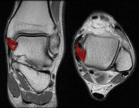 Deltoid Ligament Ankle Mri