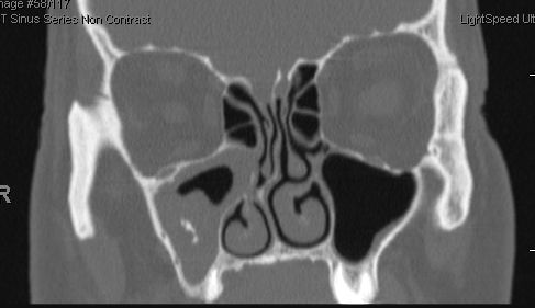 Northland Ear Nose and Throat: Odontogenic Sinusitis