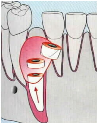 Dentistry and Medicine: Surgical management of Unerupted and Impacted teeth
