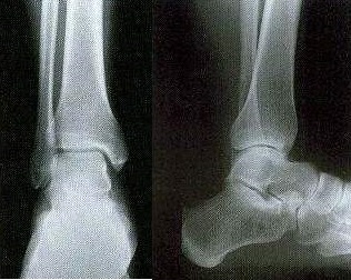 Estudo Radiográfico : ROTINA DE TORNOZELO