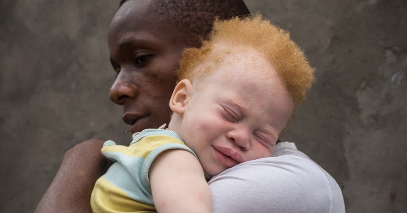 MUST READ: Albinism Is Not A Curse!