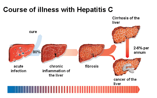 Hepatitis Overview, Types, Prevention, Treatment, Medicines: What Are ...