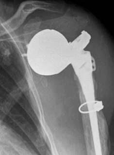 Shoulder Arthritis / Joint Replacement : Dislocation after reverse ...