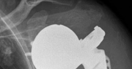 Shoulder Arthritis / Joint Replacement : Dislocation after reverse ...