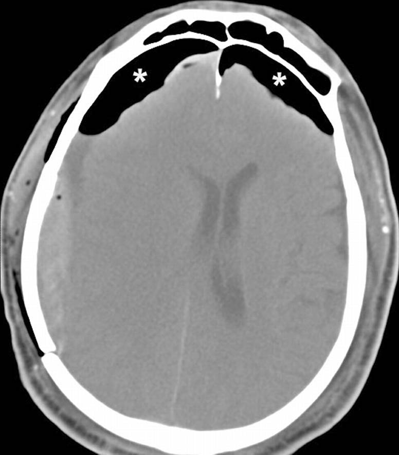ABC Radiology Blog: The Mount Fuji Sign