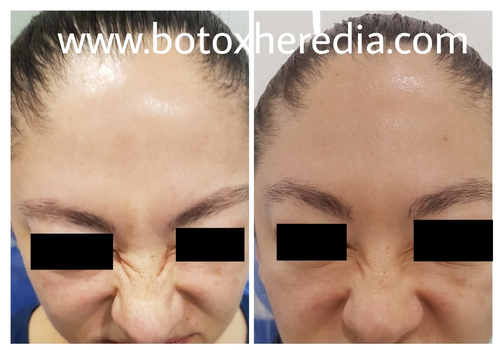 Botox, Acido Hialurónico, Bichectomia, Invisible Touch Hilos Pdo