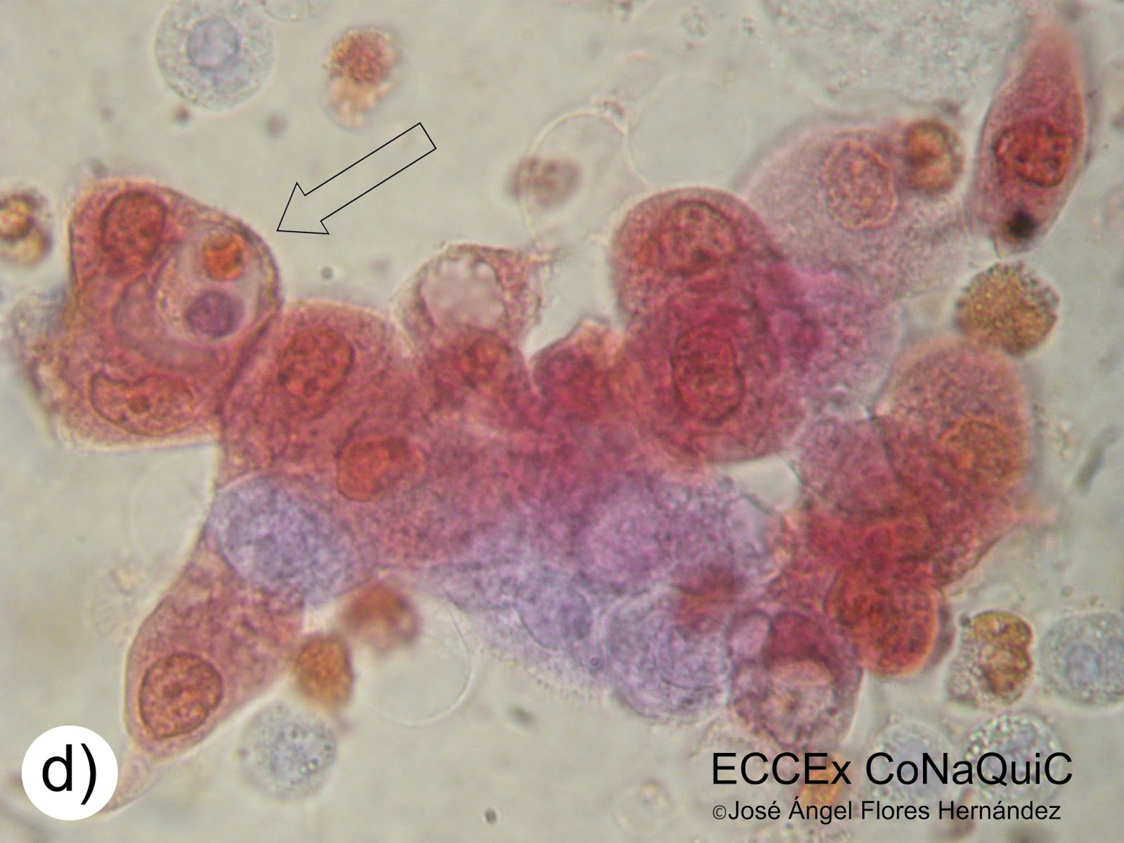 Caso UR-febrero-16 (Enfoque: Uroepitelio)