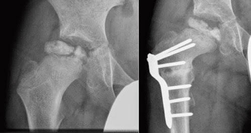 Νόσος του Πέρθες (Perthes Disease): Συχνές ερωτήσεις