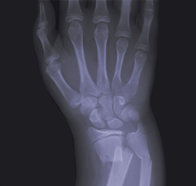 A Deeper Look Into X-Rays