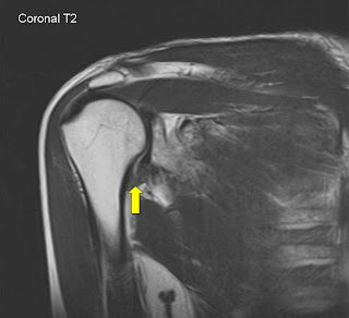 mricases: Adhesive Capsulitis - Frozen Shoulder - MRI features