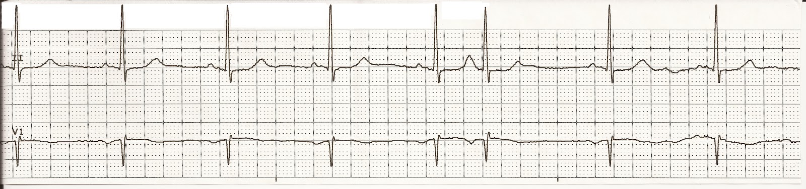 EKG Rhythm Strip Quiz 4