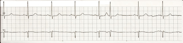 EKG Rhythm Strip Quiz 4
