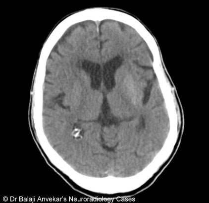 Dr Balaji Anvekar FRCR: Hemichorea hemiballismus in non ketotic ...