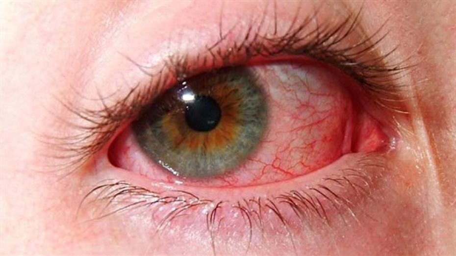 Ce que tu cherche : 10 raisons vos yeux sont injectés de sang