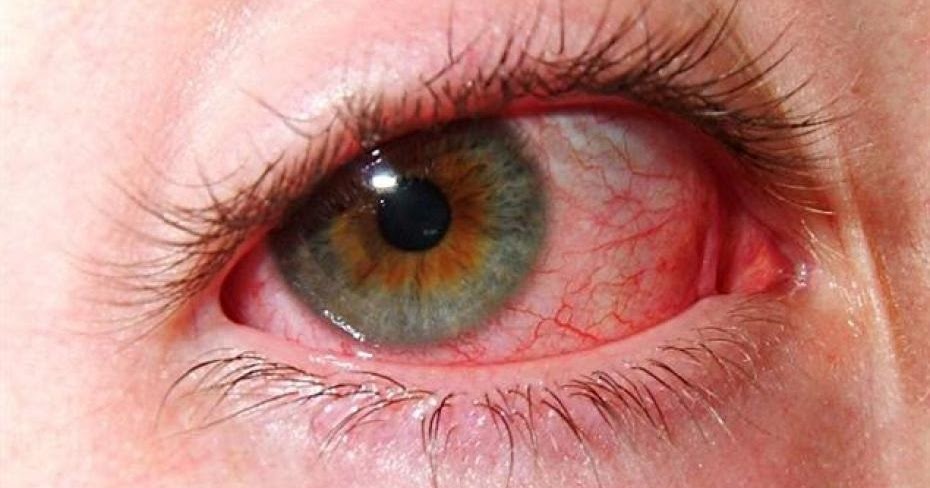 Ce que tu cherche : 10 raisons vos yeux sont injectés de sang
