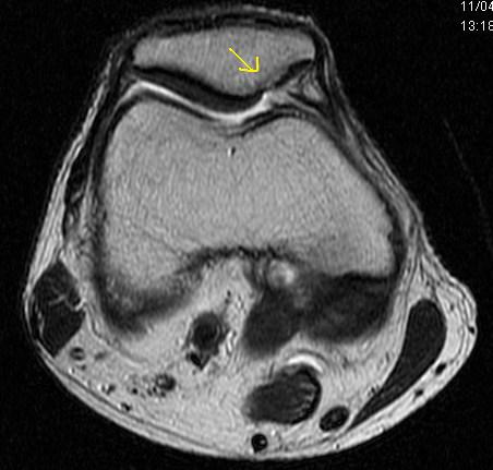 Articular cartilage Defect- MRI - Sumer's Radiology Blog