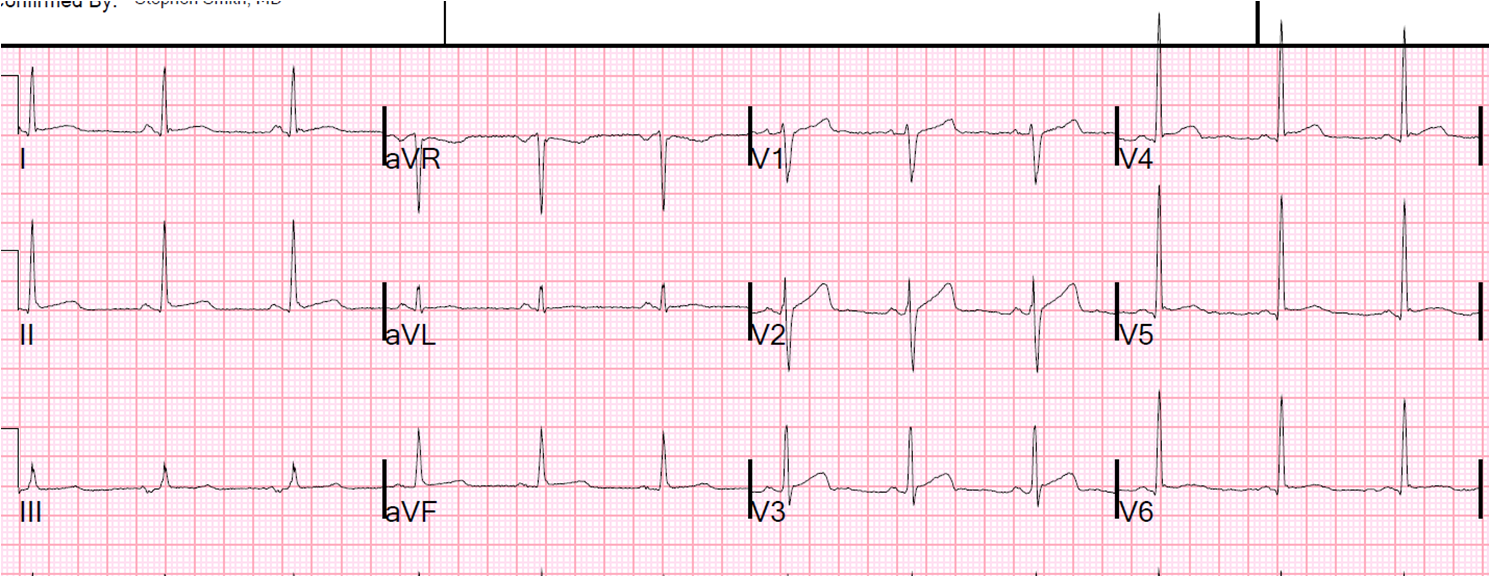 Dr. Smith's ECG Blog: Is it Wellens' Syndrome?