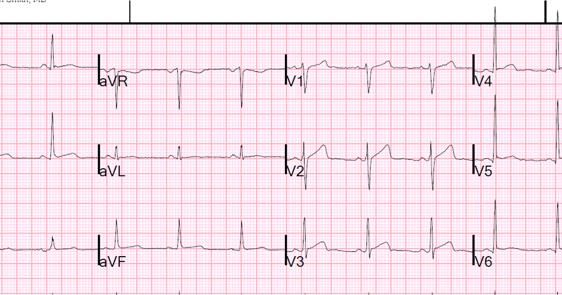 Dr. Smith's ECG Blog: Is it Wellens' Syndrome?