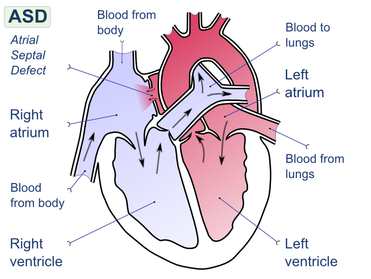 MedicoNotebook: Atrial Septal Defect (ASD)