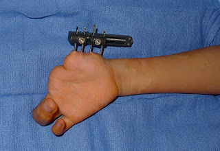 Finger Lengthening | Congenital Hand and Arm Differences | Washington ...