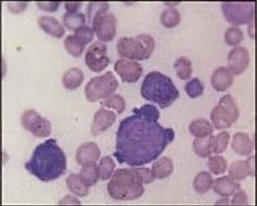 Células importantes en hematología: LEUCEMIA MIELOIDE AGUDA M6 ...