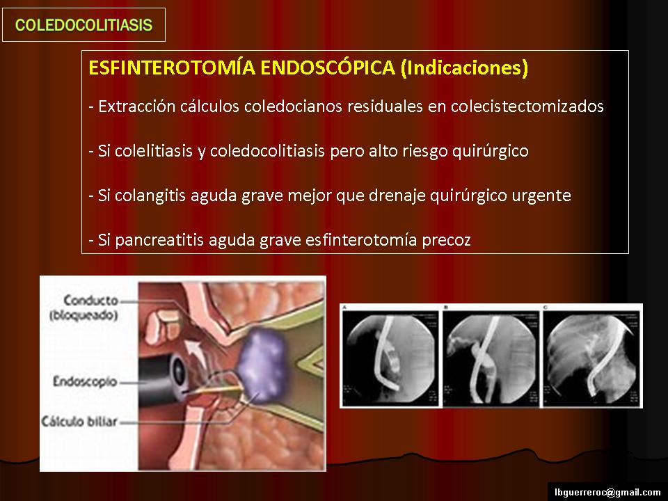 Dr. Luis B. GUERRERO CABRERA: COLÉDOCOLITIASIS. (CÁLCULOS=Litiasis, EN ...