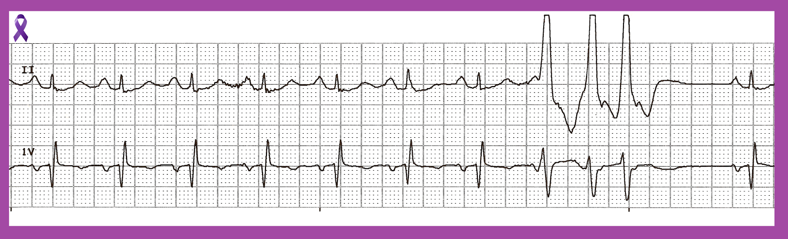 Practice EKG Strips 358