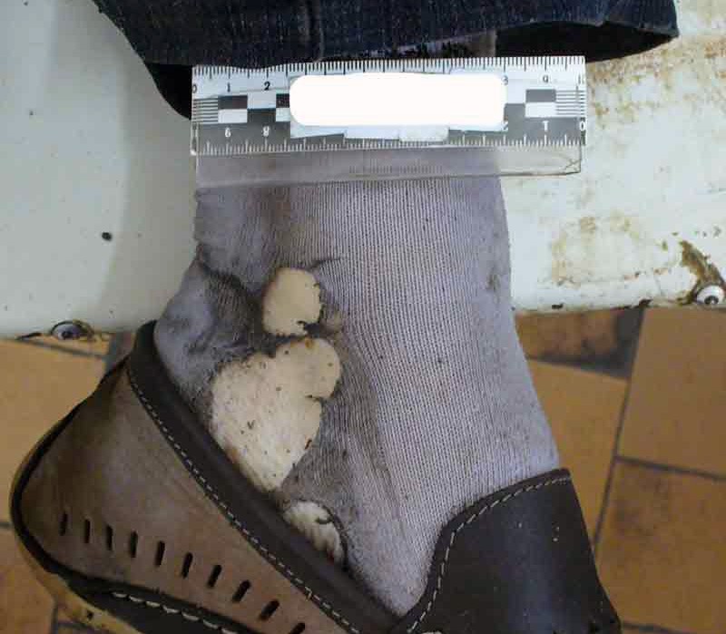 Deformutilation: Lightning Burns