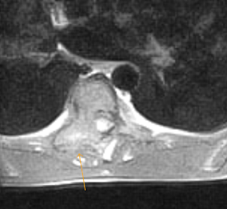 Aneurysmal bone cyst- MRI - Sumer's Radiology Blog
