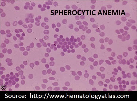 Lab Atlas: Spherocytic Anemia