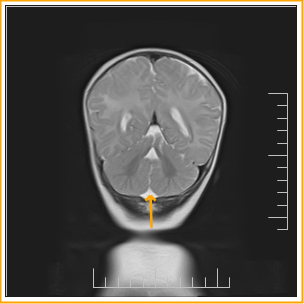 Joubert's Syndrome-MRI - Sumer's Radiology Blog