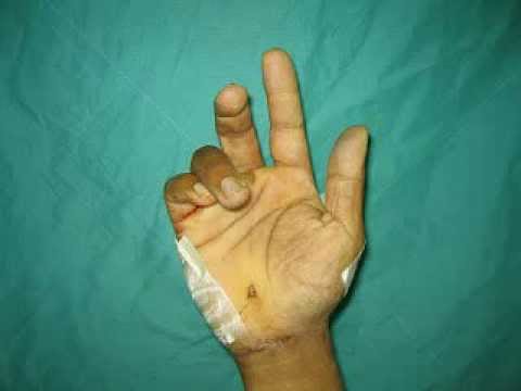 mano en garra o nervio mediano