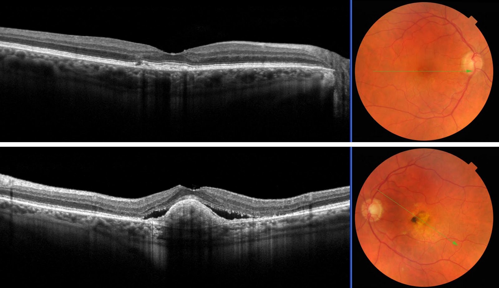 Tomografía de Coherencia Óptica