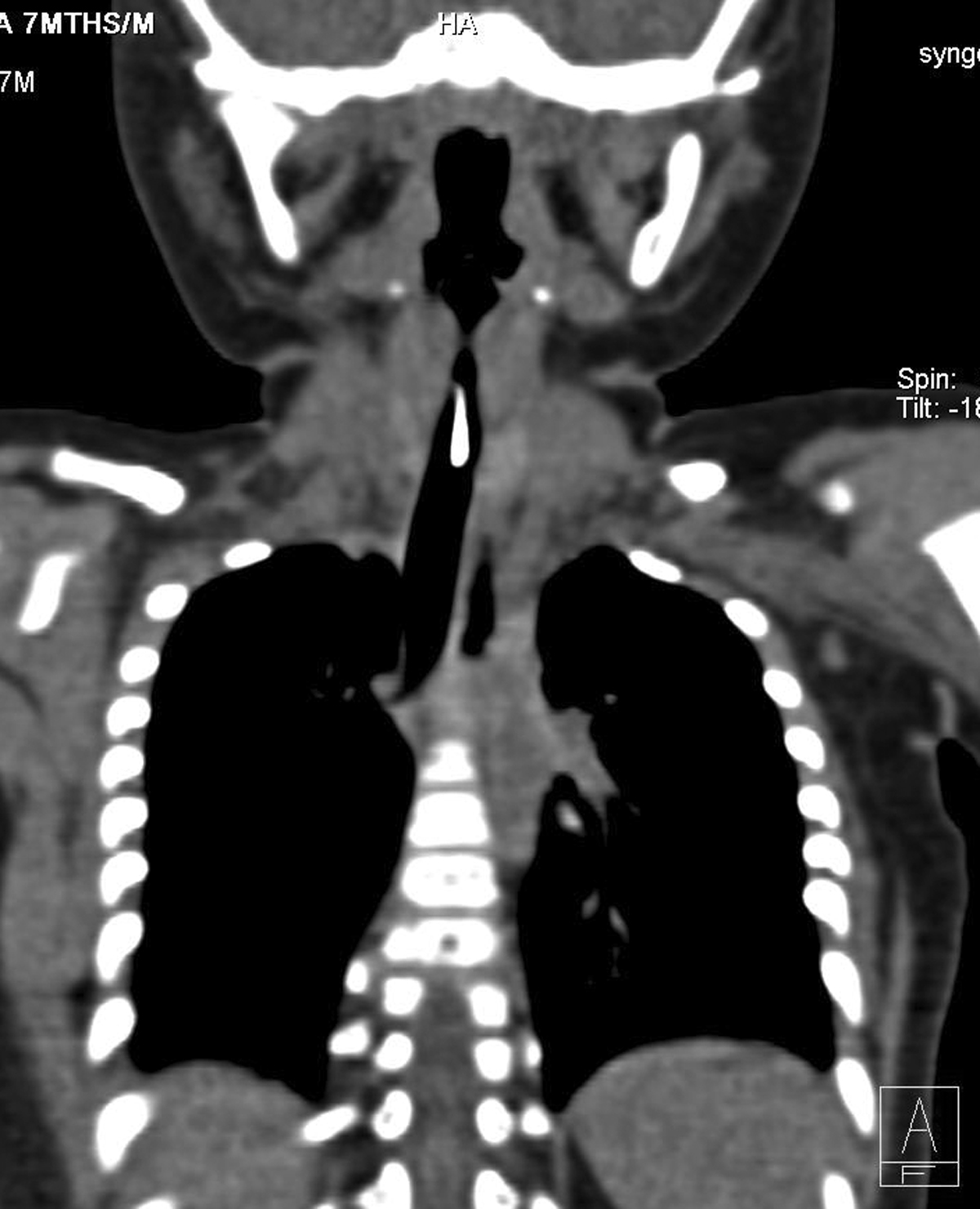 Radiodiagnosis - Imaging is Amazing-Interesting cases: Tracheal Foreign ...