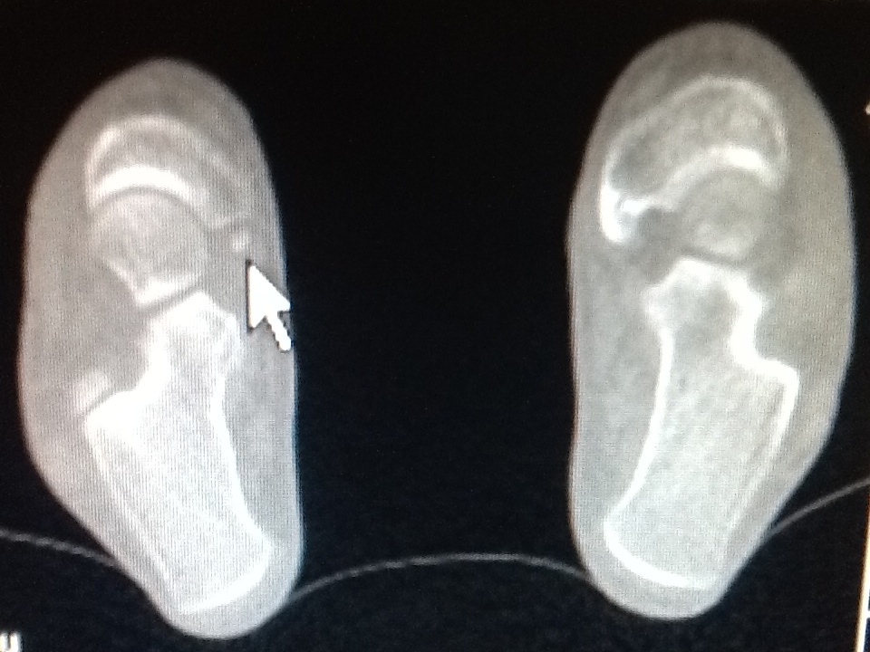 Foot and Ankle Problems By Dr. Richard Blake: Images for Os Navicularis ...