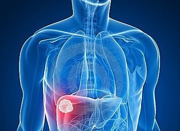 Adult primary liver cancer