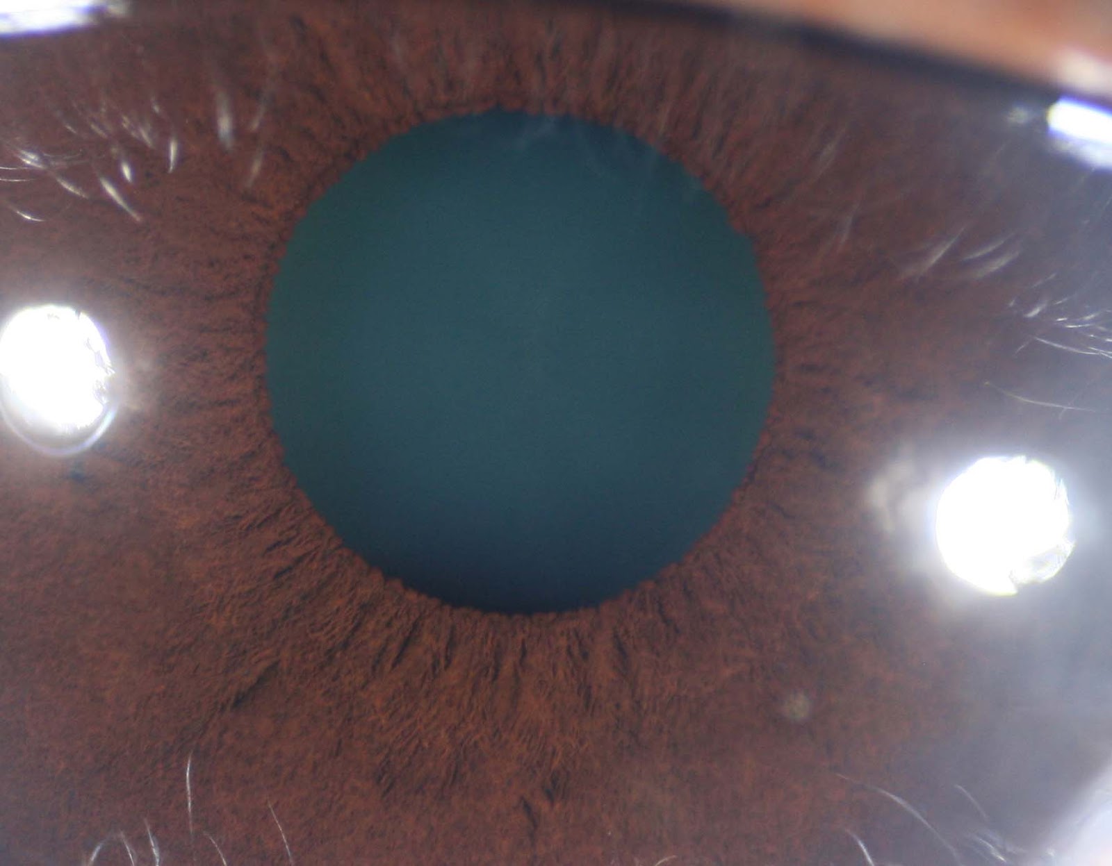 Modern & Multidimensional Iridology: Iris Signs on Hematogenic Iris ...