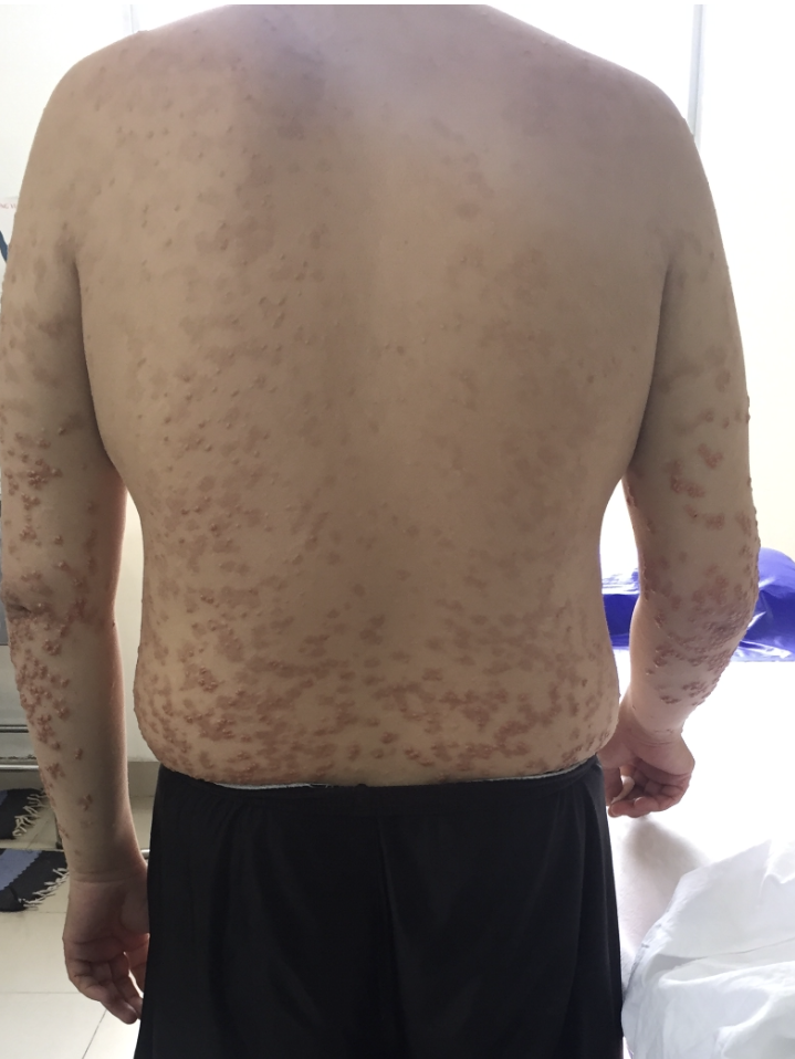 VIETNAMESE MEDIC ULTRASOUND: CASE 502: DIFFUSE SKIN XANTHOMA, Dr DƯƠNG ...