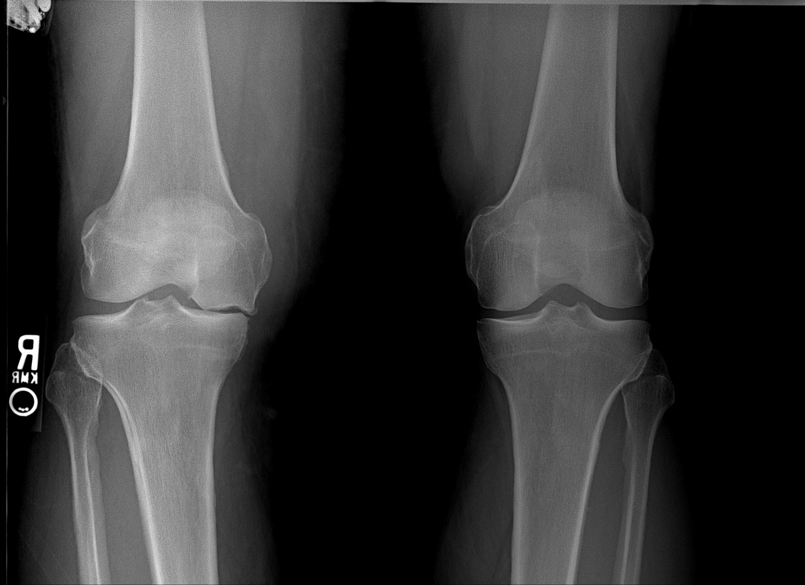 Ortho On The Web Newsletter: Post Arthroscopy Osteonecrosis of the Knee