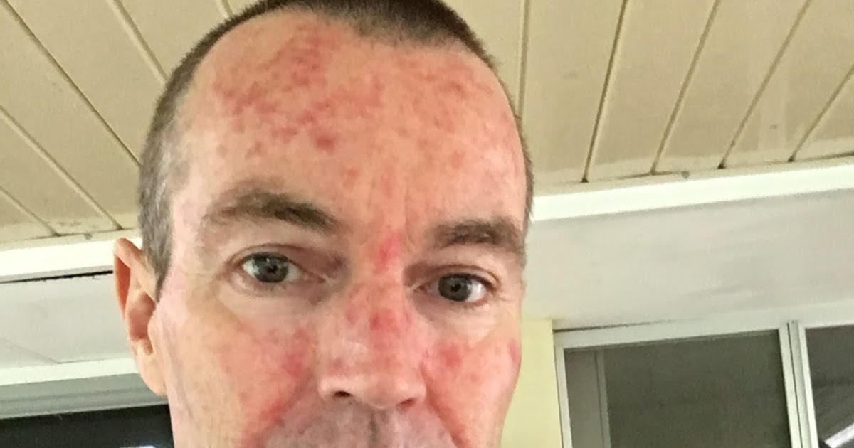 Efudix Treatment: Day 9 - Light tightening on face