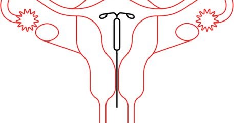 My Mirena IUD Experience- Deciding Which IUD was Right for Me