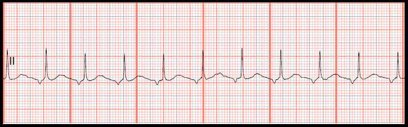 Float Nurse: Junctional Rhythm Quiz 300