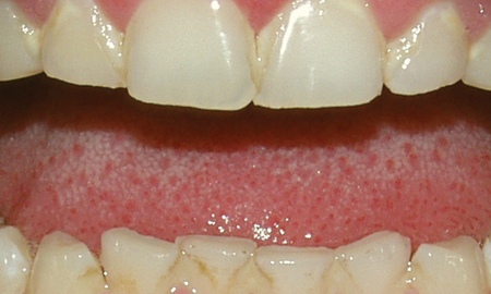 Palm Beach Smiles - Cosmetic Dentistry & 6 Month Braces: What 10 Common ...