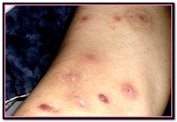 Lava Bean: Help! Scars and Boils and Rosehip oil.