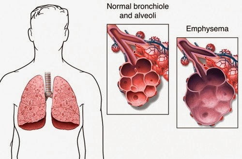 Signs of emphysema | Signs of emphysema