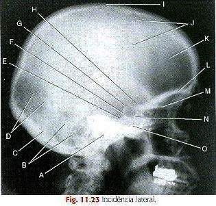 Sintonize na Radiologia: Seios da Face e Cranio