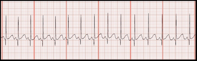 Practice EKG Rhythm Strips 118