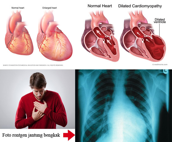OBAT HERBAL BAHAN ALAMI TERPERCAYA: Obat Penyakit Jantung Bengkak