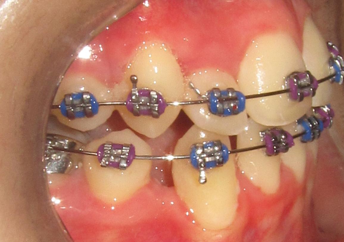 practical orthodontics: Anterior labial root torque