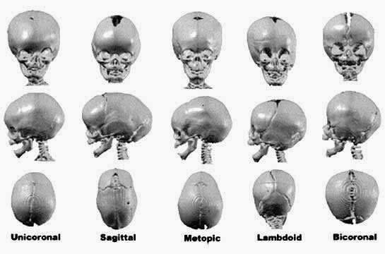 A Beautiful and Interesting Adventure; Our journey with Craniosynostosis.